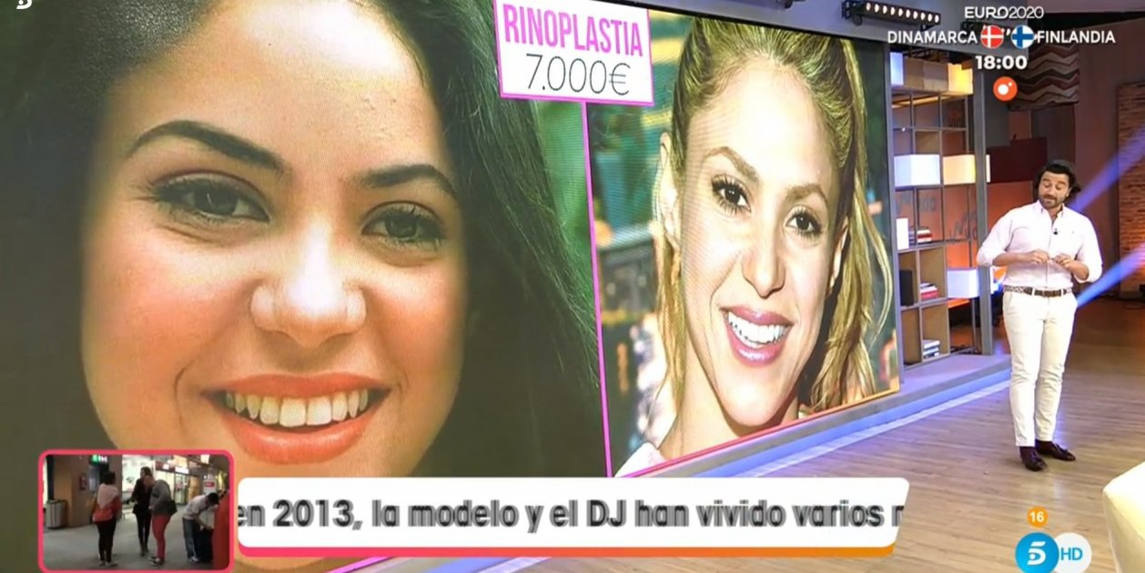 Shakira, su antes y después con cirugía estética: 65 mil euros según ...