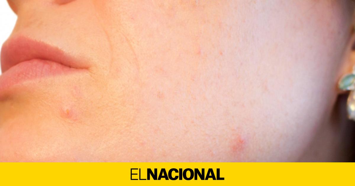 Qué puedes hacer para prevenir las espinillas