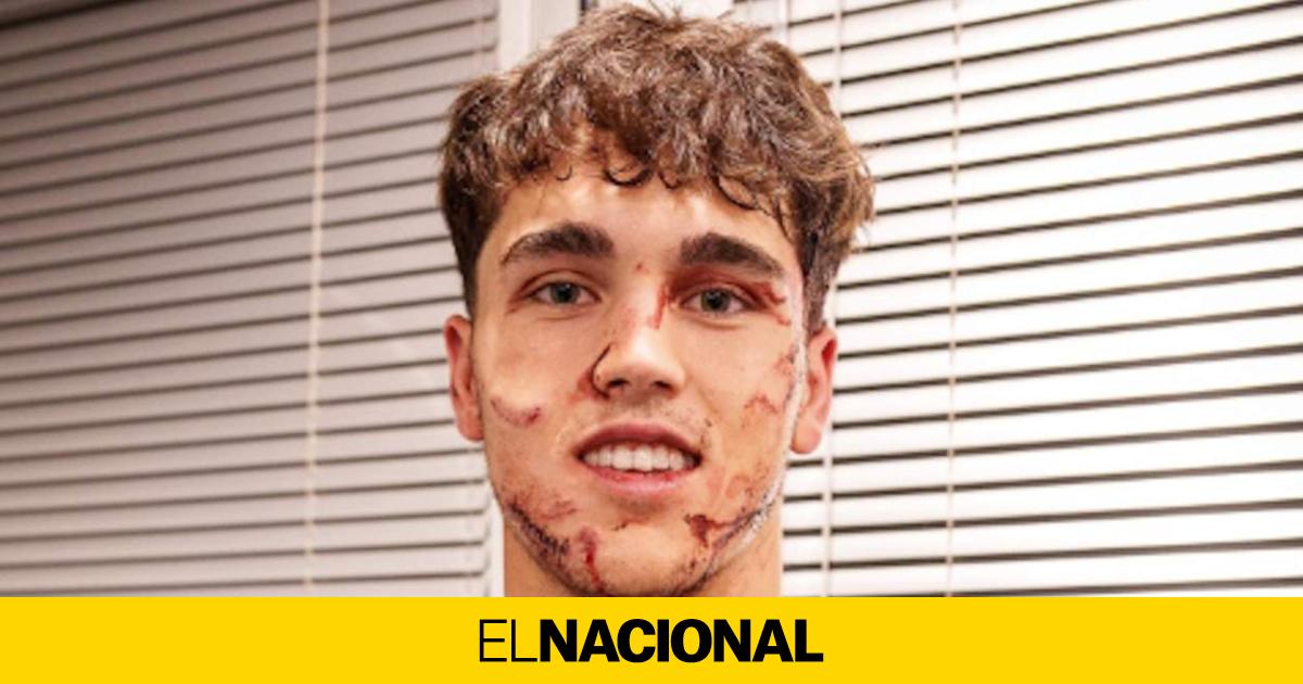 Així ha quedat la cara de Cubarsí després dels 10 punts de sutura